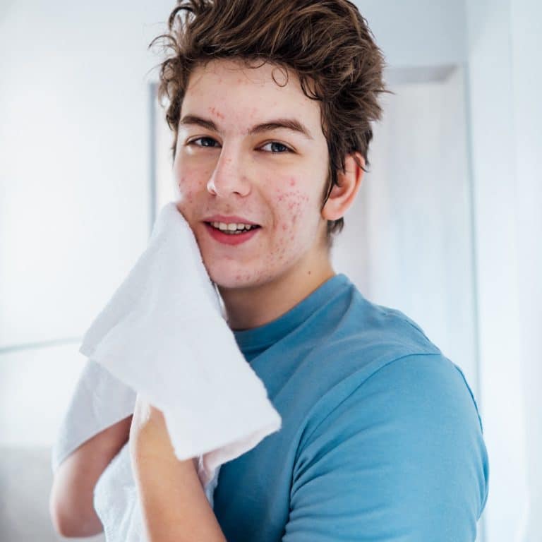 Acne Treatment In Flowood MS Sculpt Aesthetics Wellness acne-treatment-in-flowood-ms-sculpt-aesthetics-wellness